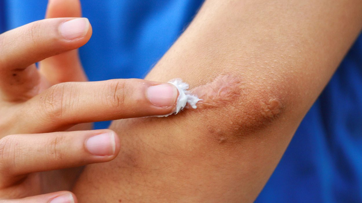 Anti scar cream for reducing redness and improving skin flexibility ...