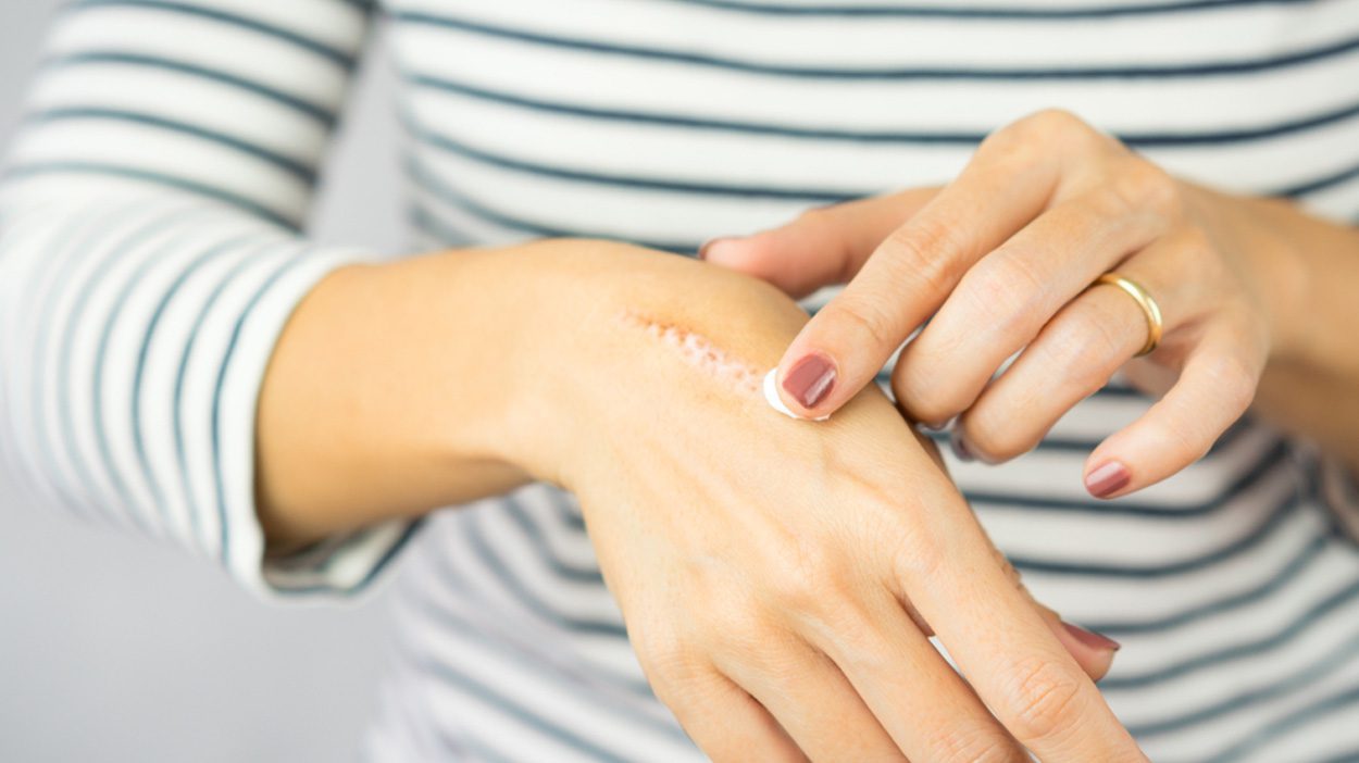 How to treat a fresh scar | ALHYDRAN CO UK